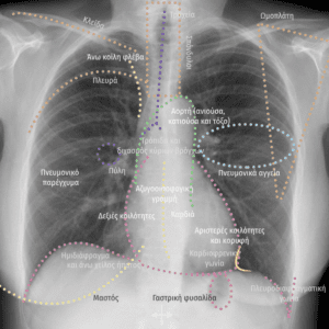 Εισαγωγή στην απλή ακτινογραφία θώρακος | Klinikal